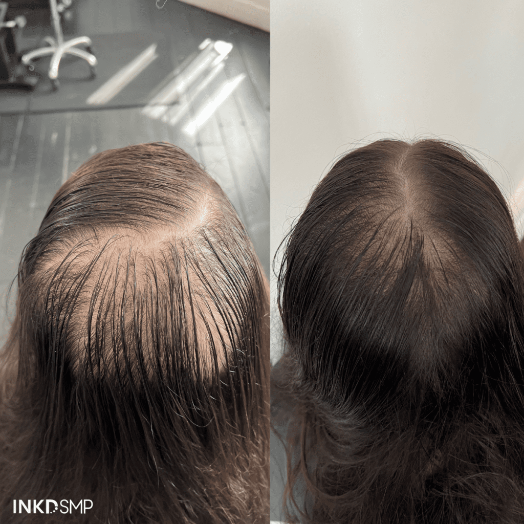 SMP Melbourne | Scalp Micropigmentation | Hair Tattoo